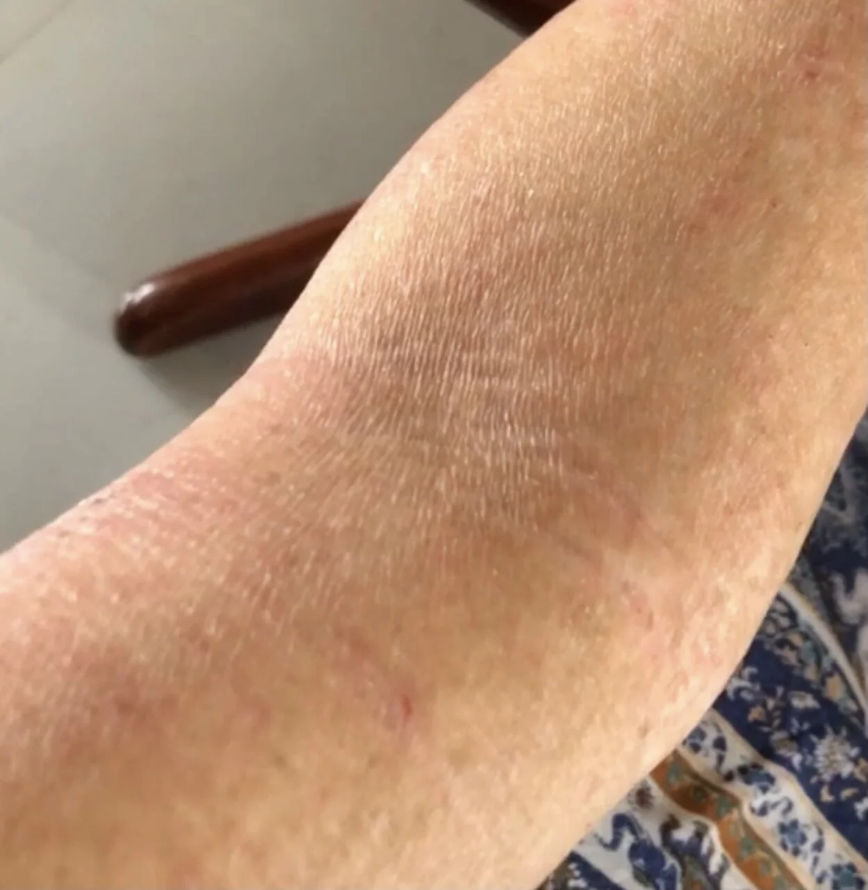 Stages of Skin Healing — Decoding Topical Steroid Withdrawal