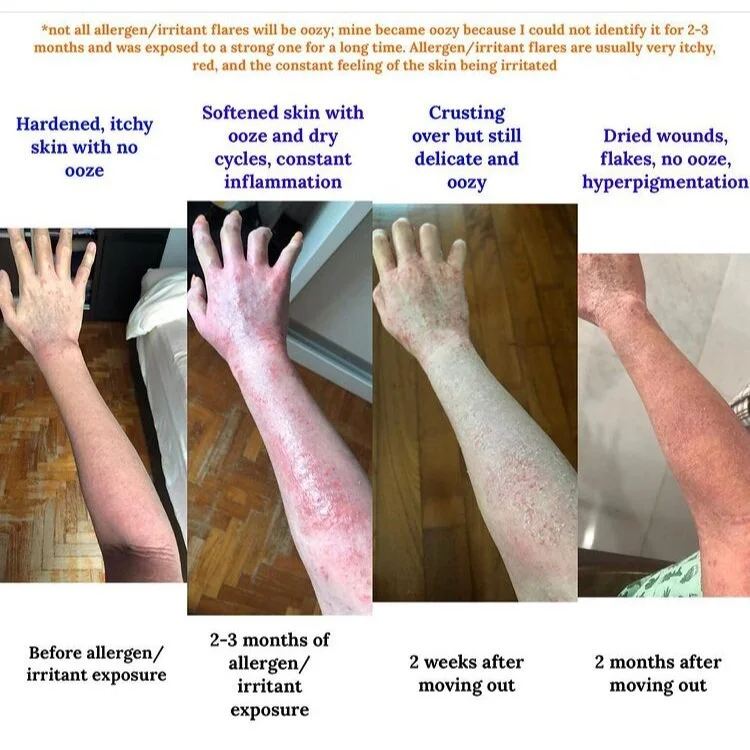 Identifying and Managing Allergen/Irritant Flares — Decoding Topical ...