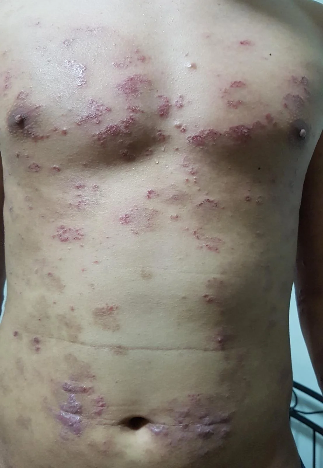 Identifying and Managing Fungal Infections — Decoding Topical Steroid ...