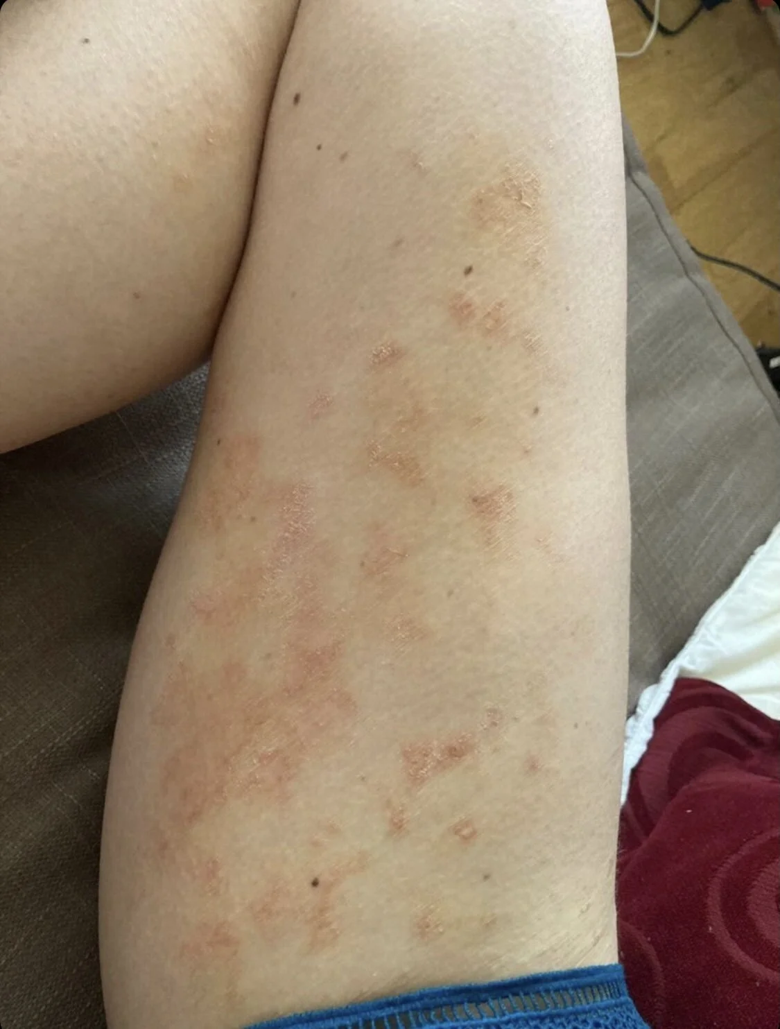 Identifying and Managing Fungal Infections — Decoding Topical Steroid ...