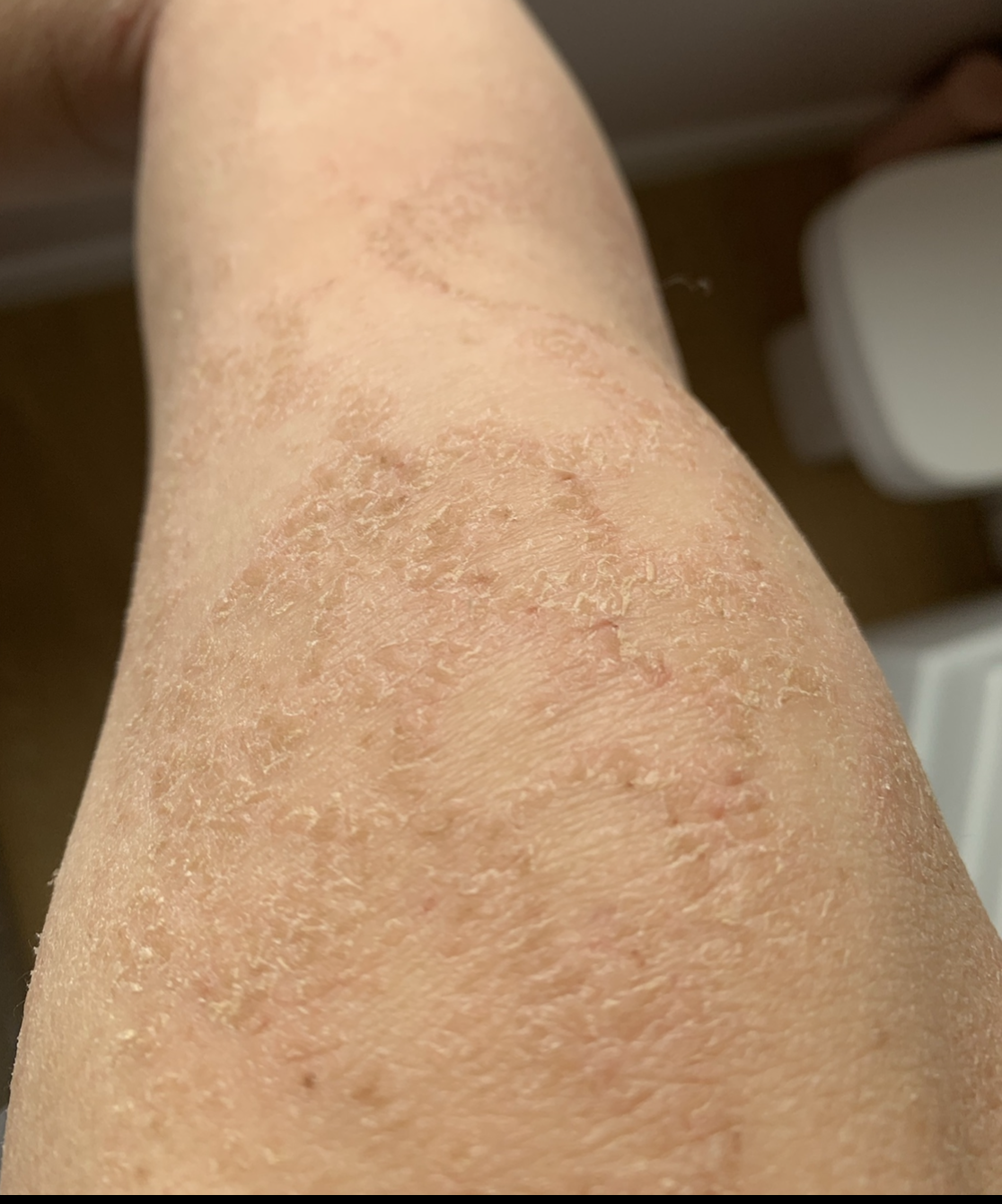 Identifying and Managing Fungal Infections — Decoding Topical Steroid ...