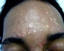 Identifying and Managing Fungal Infections — Decoding Topical Steroid ...