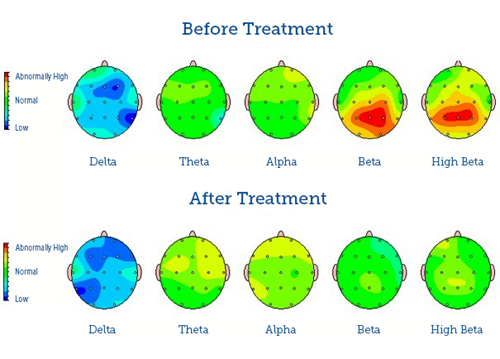 Neurofeedback Therapy (Brain Training — SWITCH
