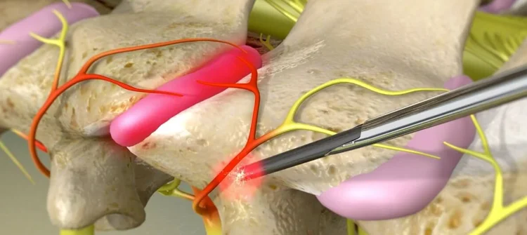 Radiofrequency Ablation — EPIC PAIN MANAGEMENT