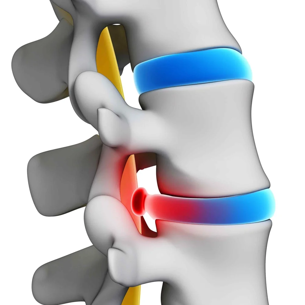 Endoscopic Discectomy — EPIC PAIN MGMT (973)866-0336