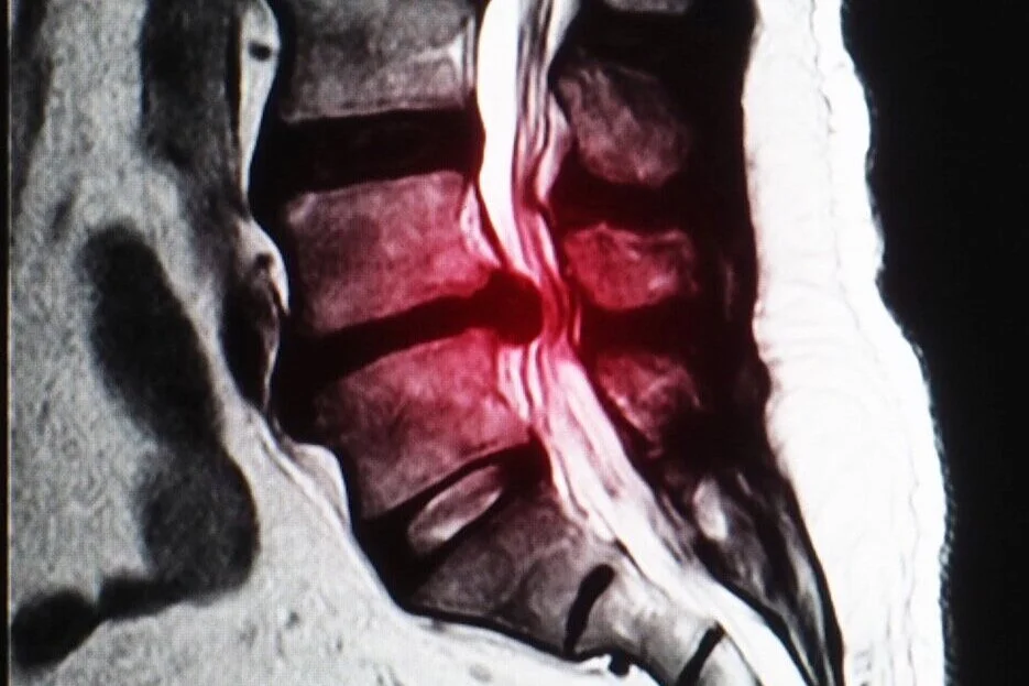 Herniated Disc — EPIC PAIN MGMT (973)866-0336