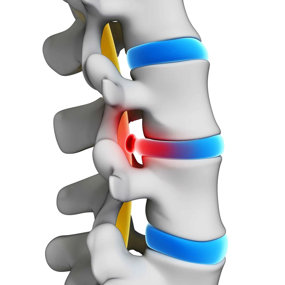 Back Pain — EPIC PAIN MGMT (973)866-0336
