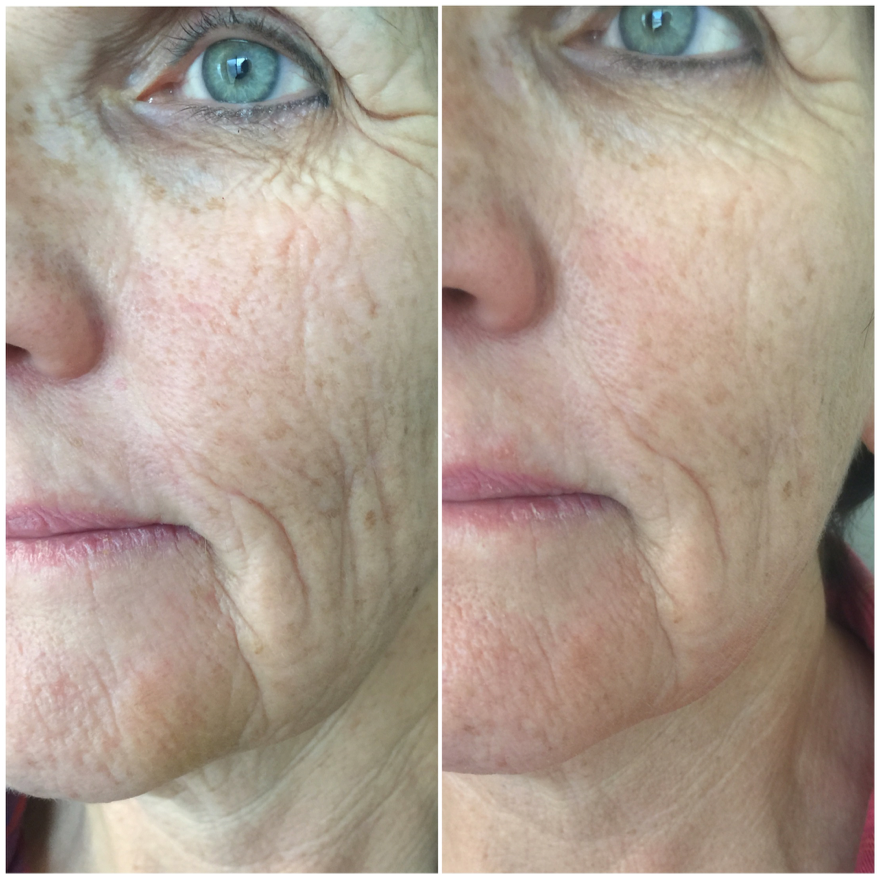 PROCELL THERAPIES MICROCHANNELING FACE and BODY — REJUVASKIN