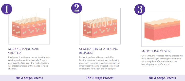PROCELL THERAPIES MICROCHANNELING FACE and BODY — REJUVASKIN