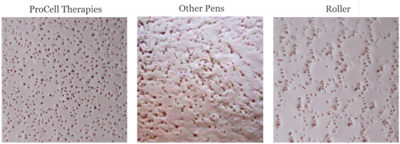 PROCELL THERAPIES MICROCHANNELING FACE and BODY — REJUVASKIN