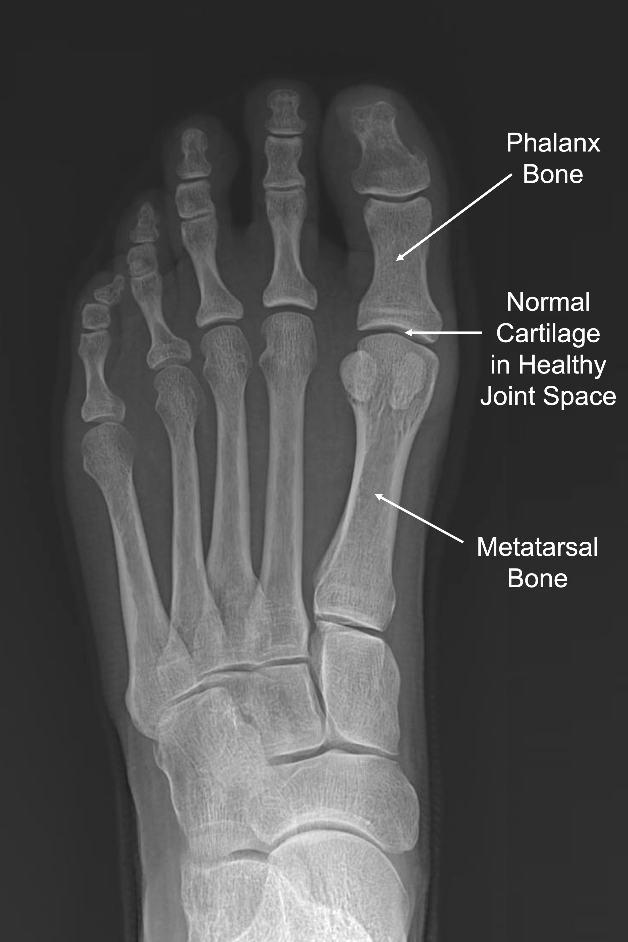 Big Toe Arthritis Daniel Bohl MD Midwest Orthopaedics At RUSH Big Toe Arthritis Daniel Bohl MD Midwest Orthopaedics At RUSH