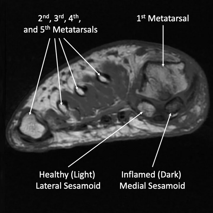 Sesamoiditis — Daniel Bohl, MD | Midwest Orthopaedics at RUSH