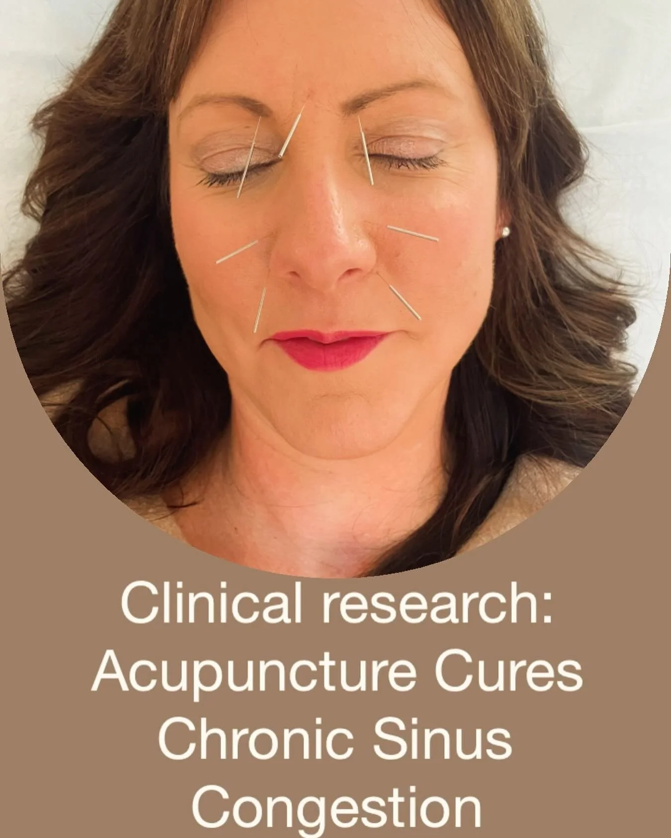 Susan Martin Acupuncture - Acupuncture Treatment and Booking