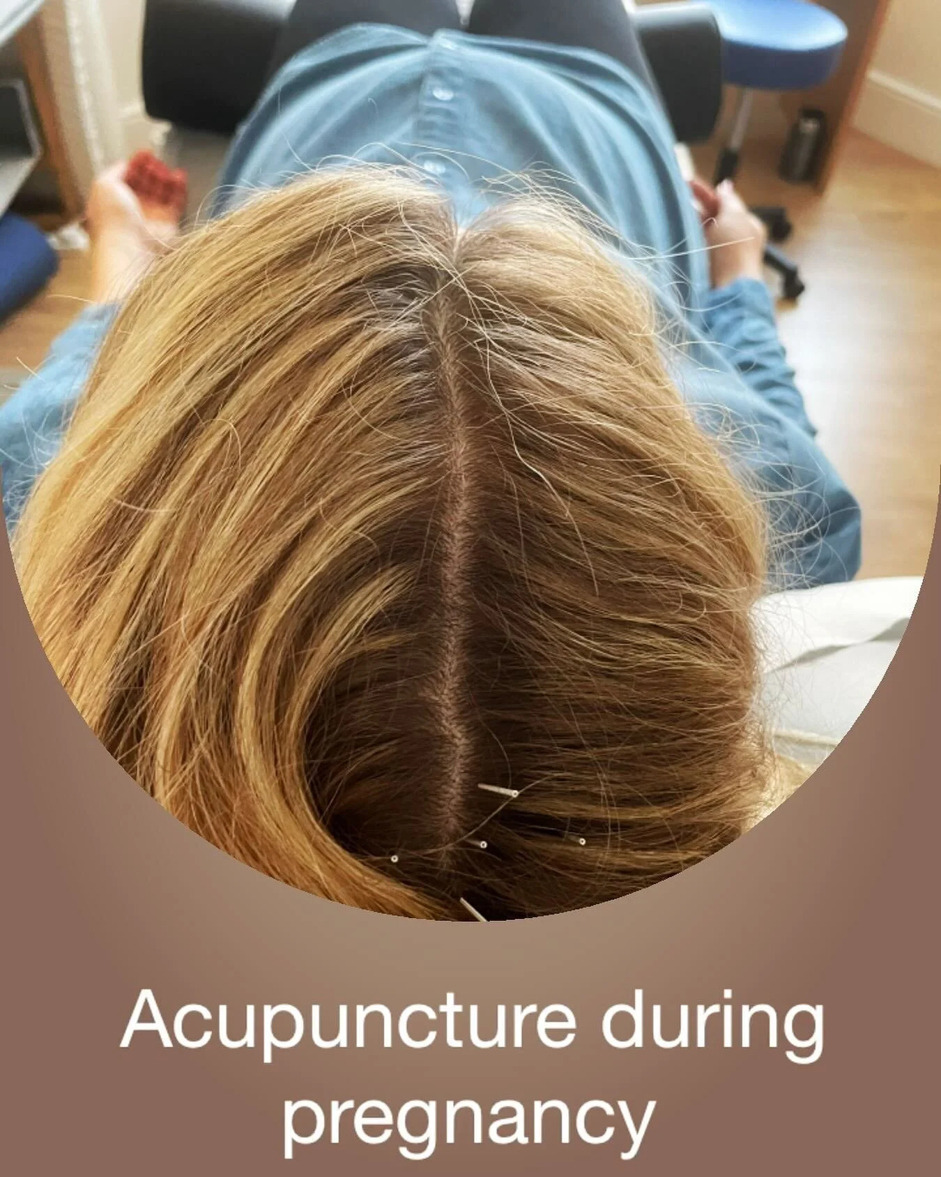 Susan Martin Acupuncture - Acupuncture Treatment and Booking