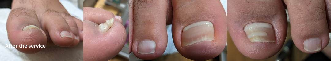 INGROWN TOENAIL CASE — Onyx Aesthetics Studio