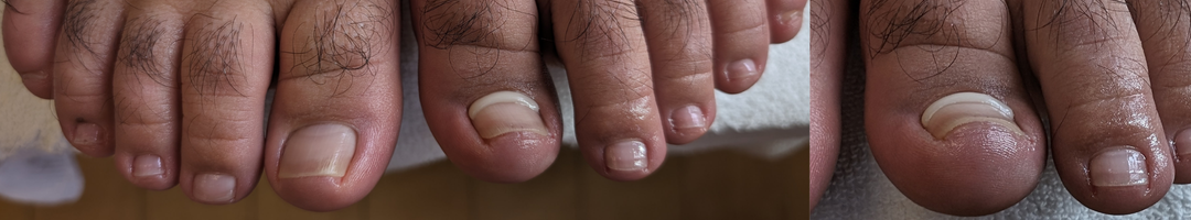 INGROWN TOENAIL CASE — Onyx Aesthetics Studio