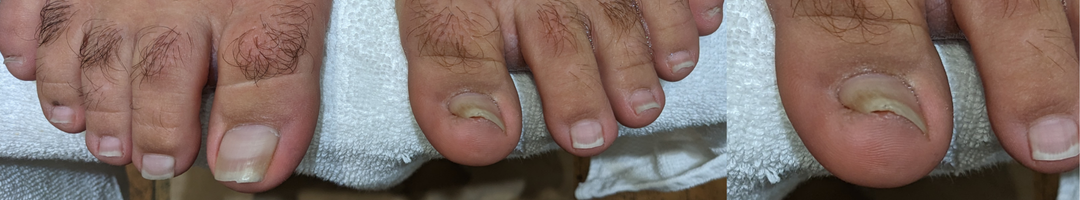 INGROWN TOENAIL CASE — Onyx Aesthetics Studio
