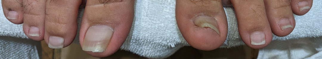 INGROWN TOENAIL CASE — Onyx Aesthetics Studio