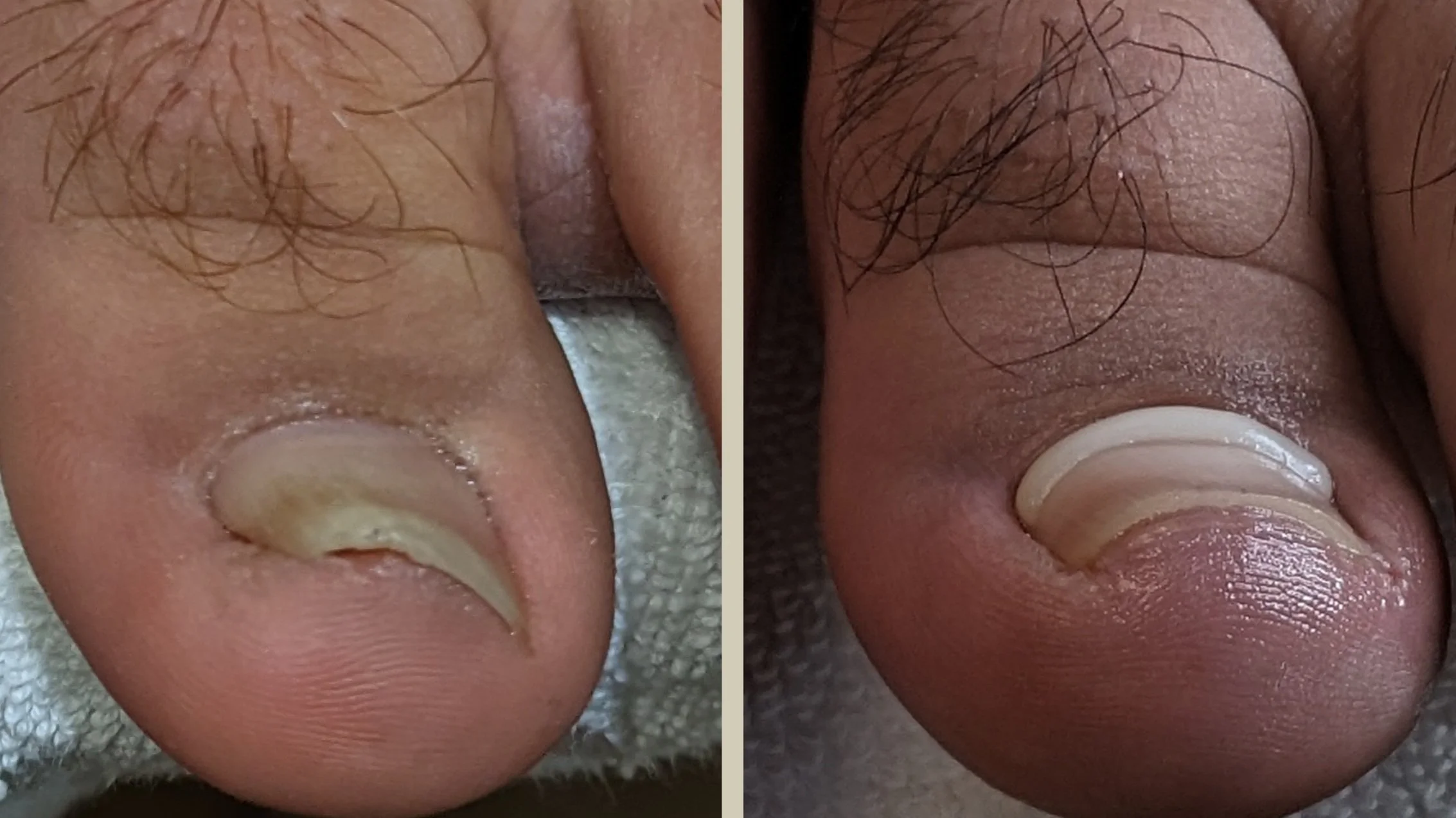 INGROWN TOENAIL CASE — Onyx Aesthetics Studio