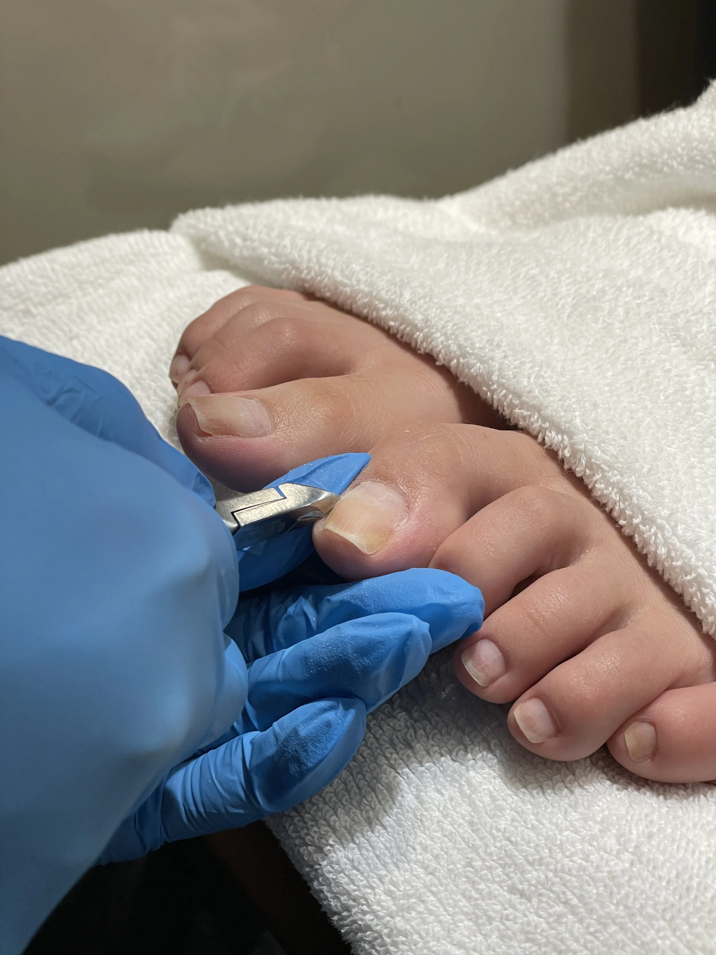 Learn what ingrown toenails are and how to prevent them — Onyx ...
