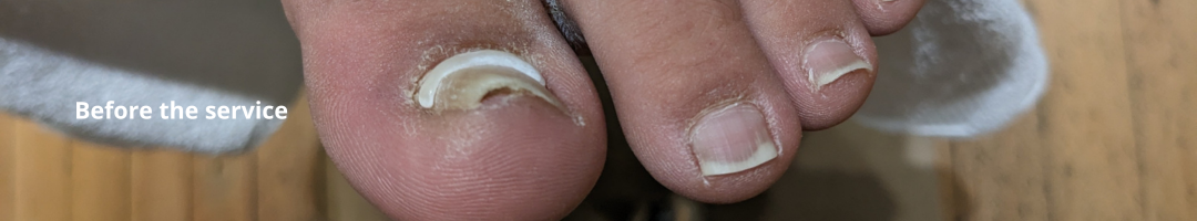 INGROWN TOENAIL CASE — Onyx Aesthetics Studio