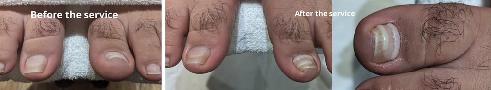 INGROWN TOENAIL CASE — Onyx Aesthetics Studio