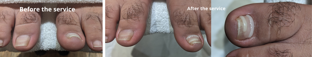 INGROWN TOENAIL CASE — Onyx Aesthetics Studio