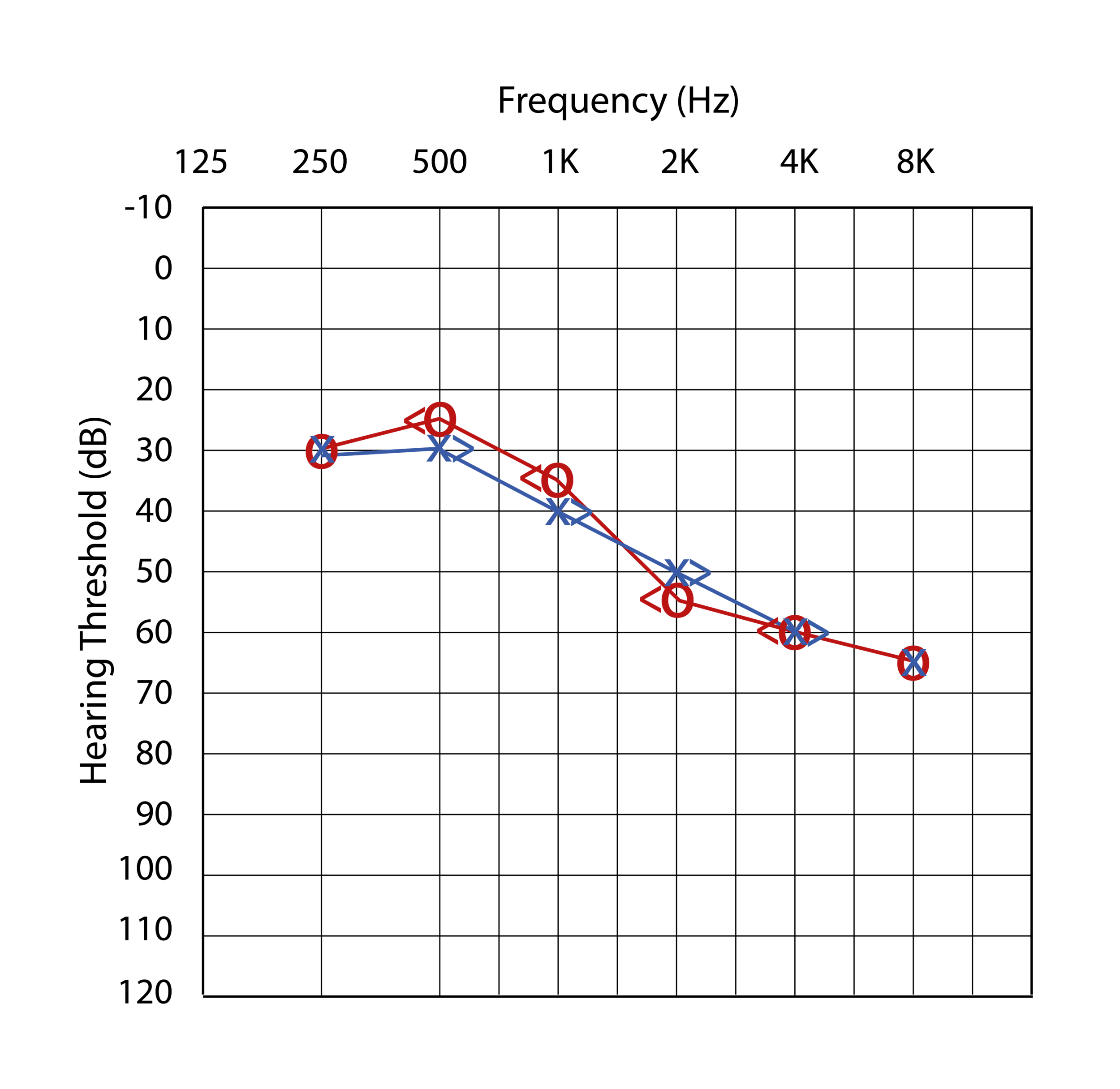 Normal Audiogram Normal Audiogram