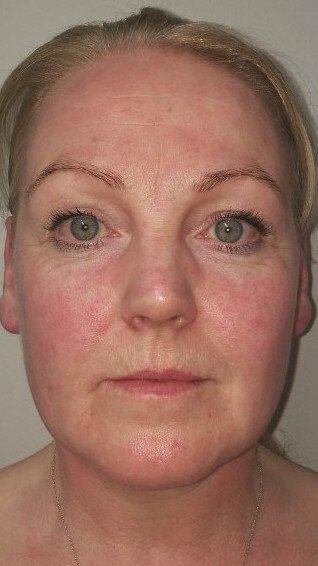Before & After — Zone Face Lift