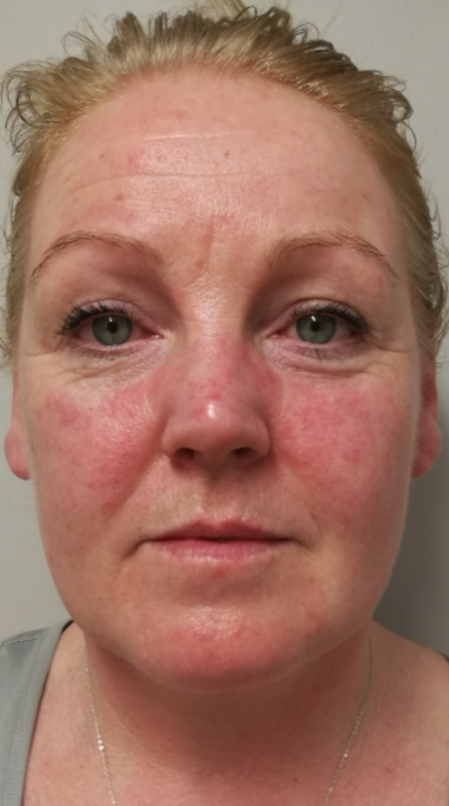 Before & After — Zone Face Lift