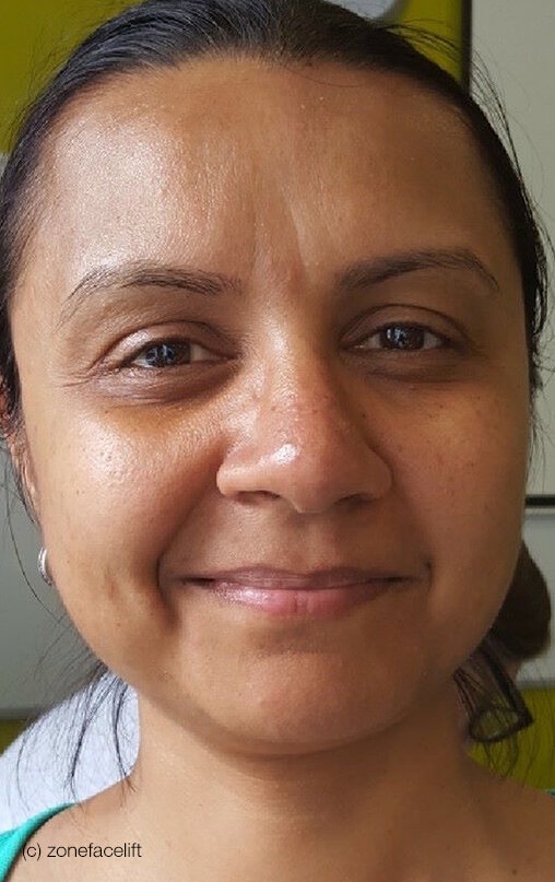 Before & After — Zone Face Lift