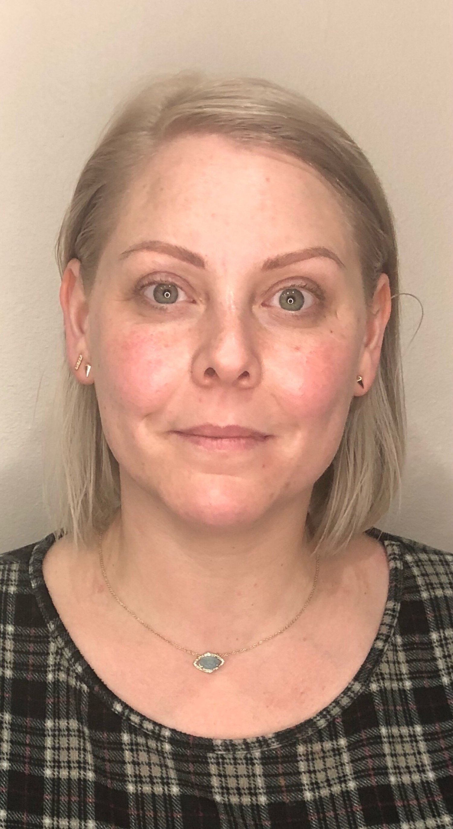 Before & After — Zone Face Lift