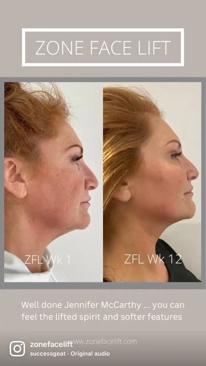 Zone Face Lift