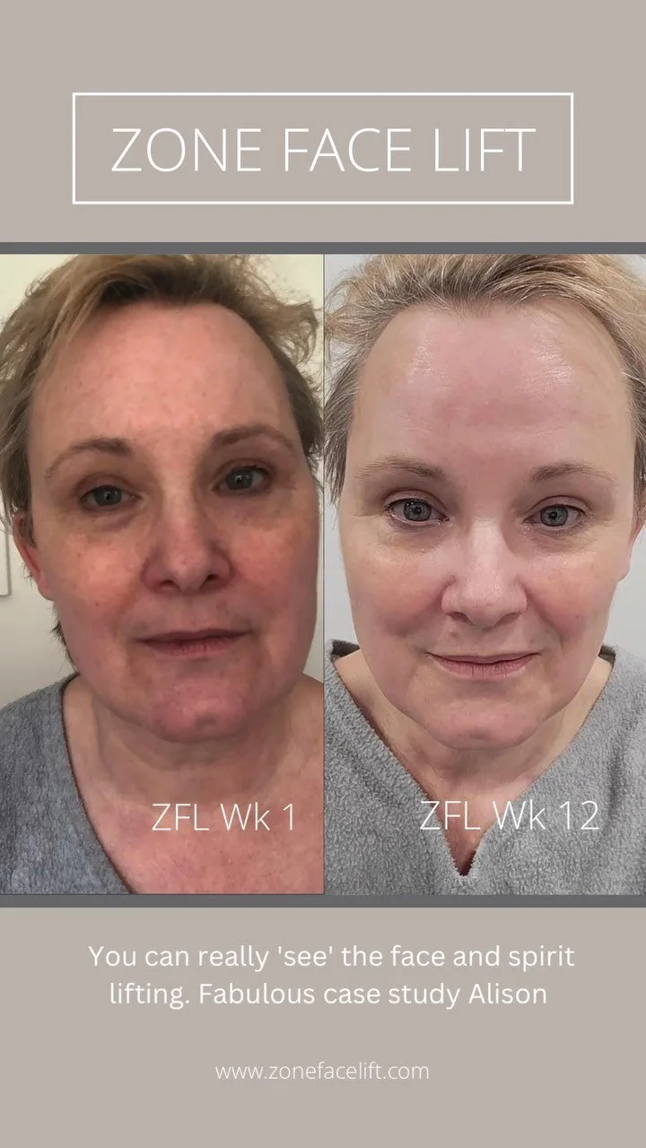 Zone Face Lift