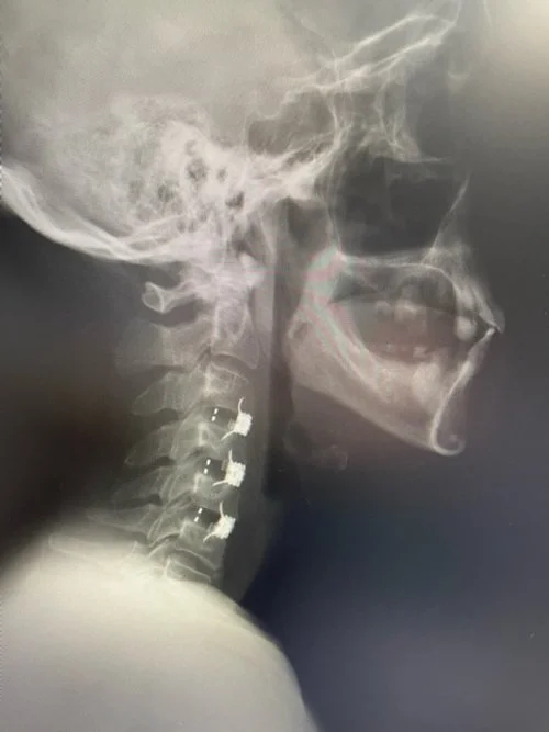 Treatments | Dr. Christopher Koebbe | Neurosurgeon | Minimally Invasive ...