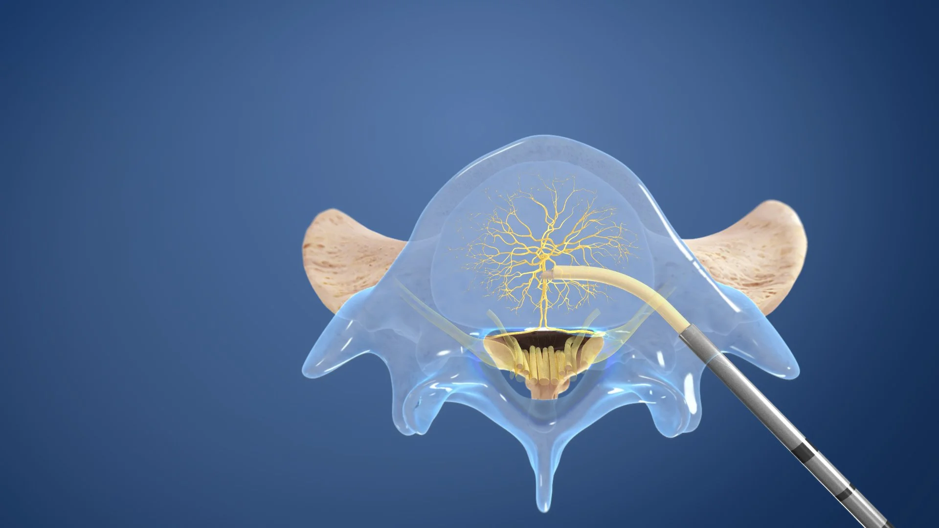 Treatments | Dr. Christopher Koebbe | Neurosurgeon | Minimally Invasive ...