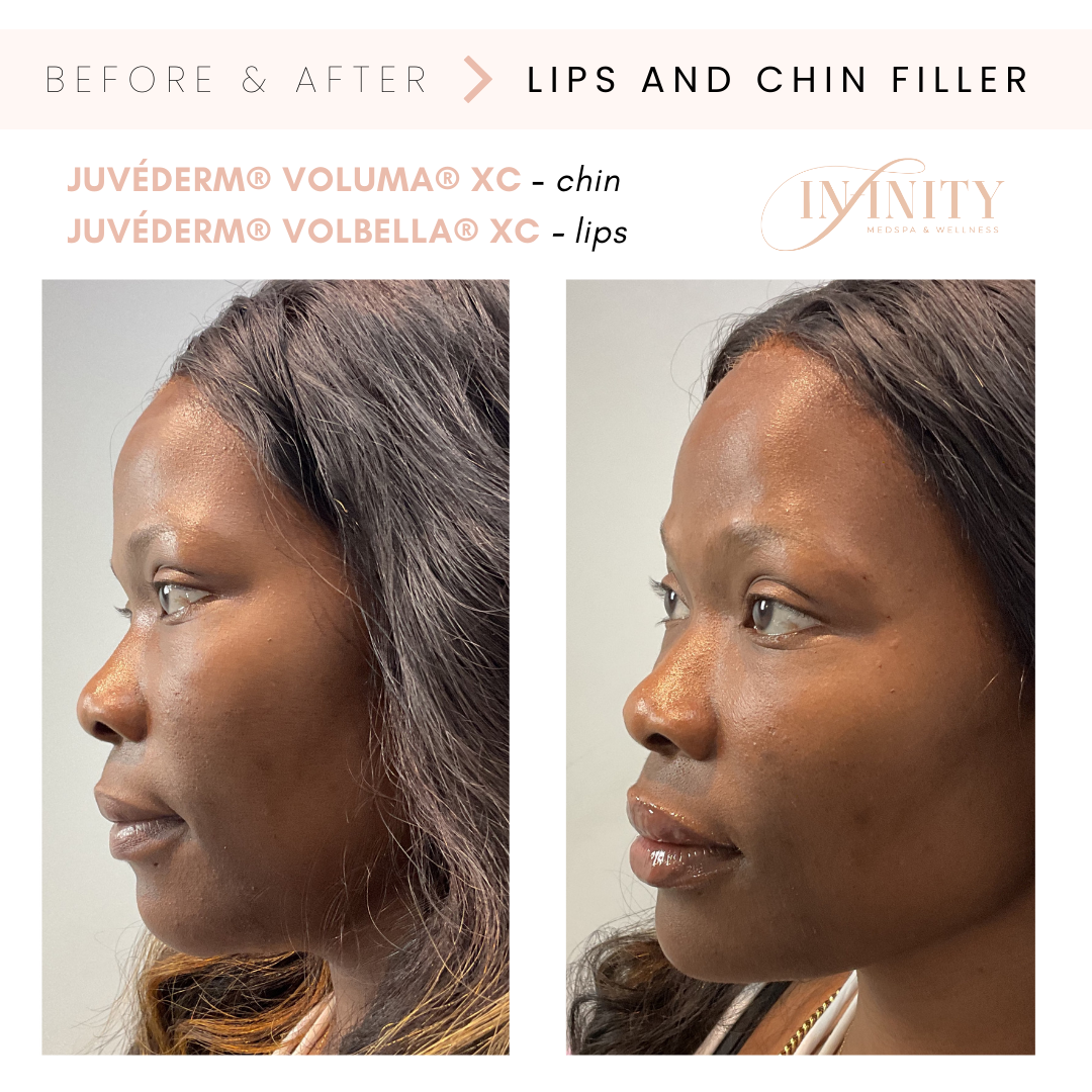 Juvederm Voluma Lips