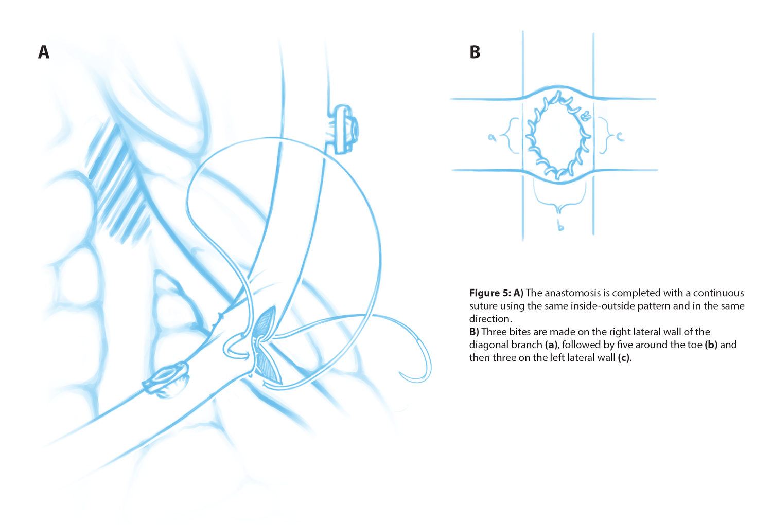 Double Coronary Bypass Using the Internal Thoracic Artery — B Cheung ...