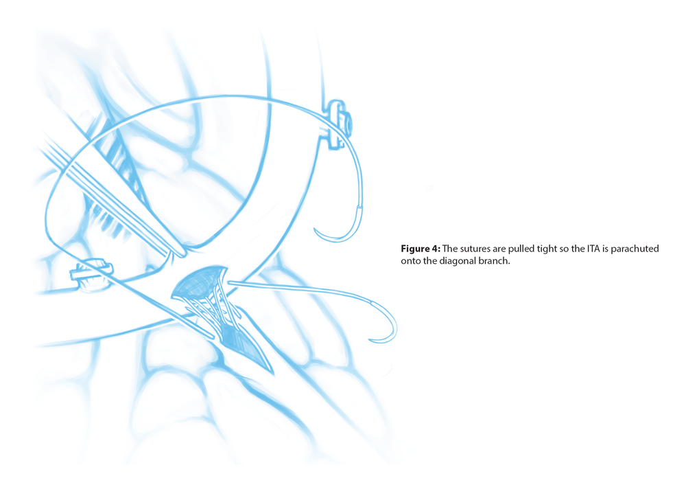Double Coronary Bypass Using the Internal Thoracic Artery — B Cheung ...