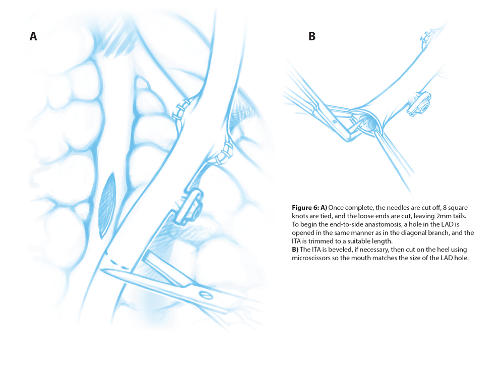 Double Coronary Bypass Using the Internal Thoracic Artery — B Cheung ...