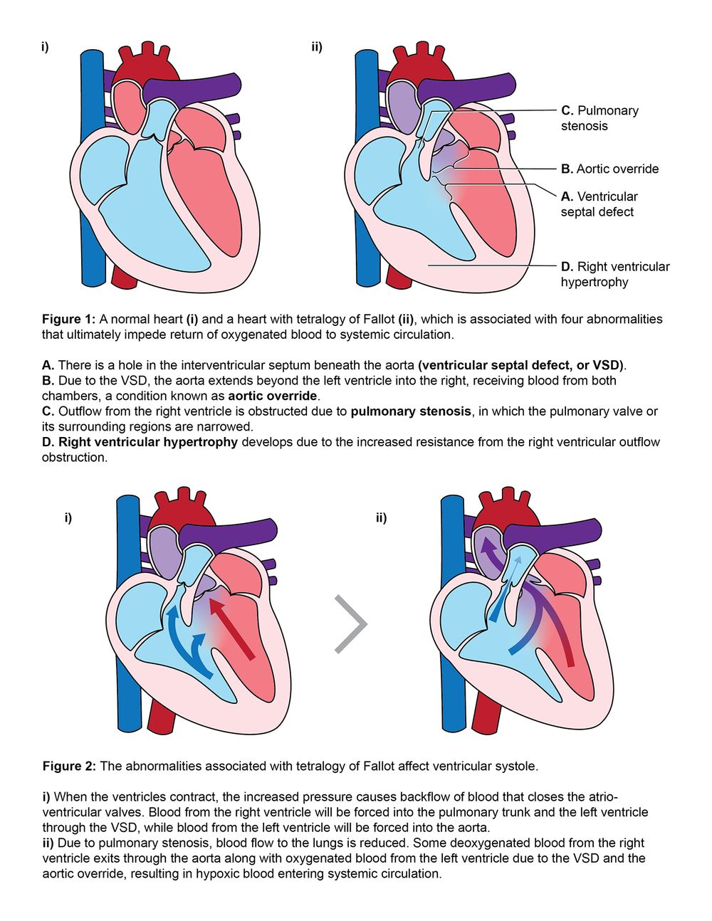 Tetralogy of Fallot — B Cheung | Biomedical Illustration