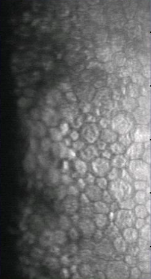Fuchs endothelial dystrophy — Abessi Eye Care & Surgery