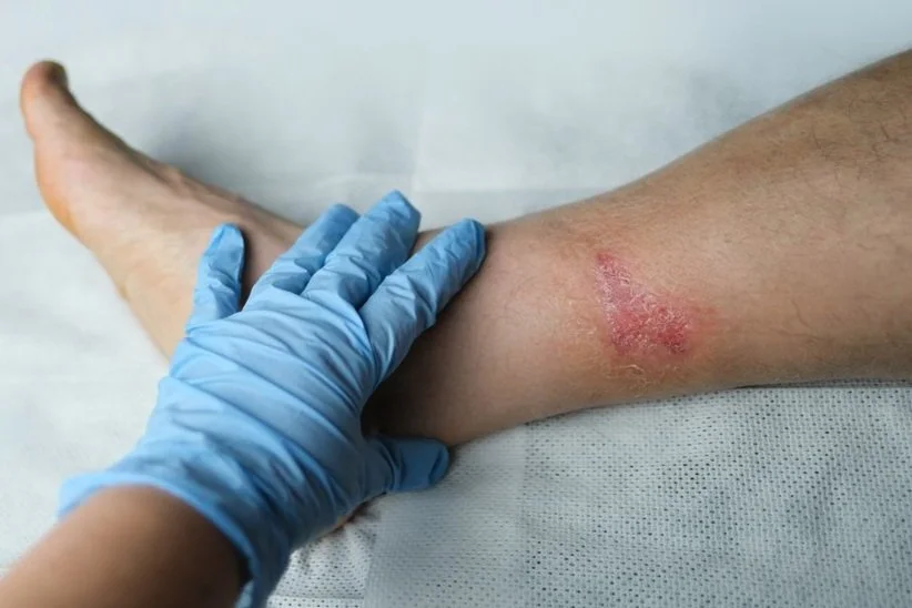 Wound — Phase2 Labs