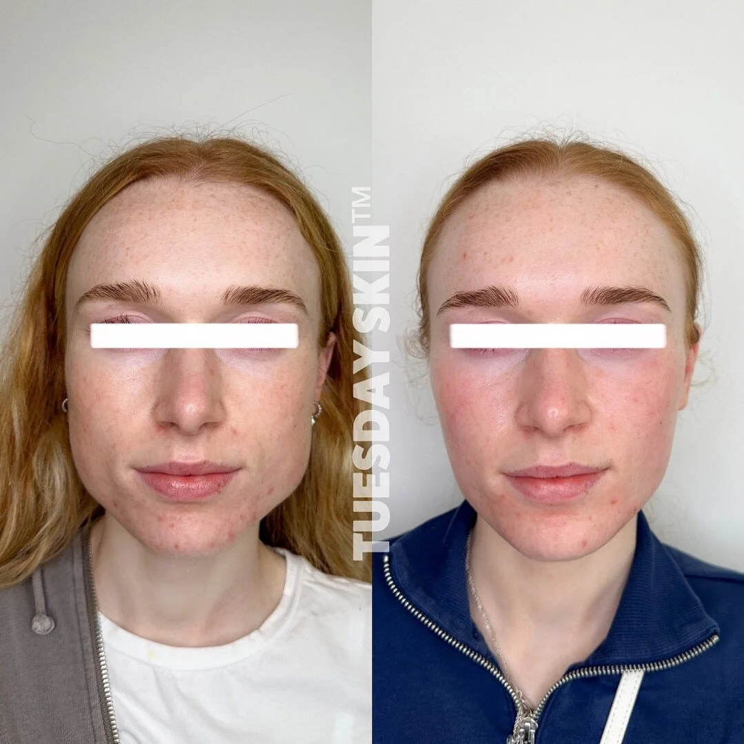 Skin Therapies Pricing - Tuesday Skin Studio, Northland, NZ — Tuesday ...