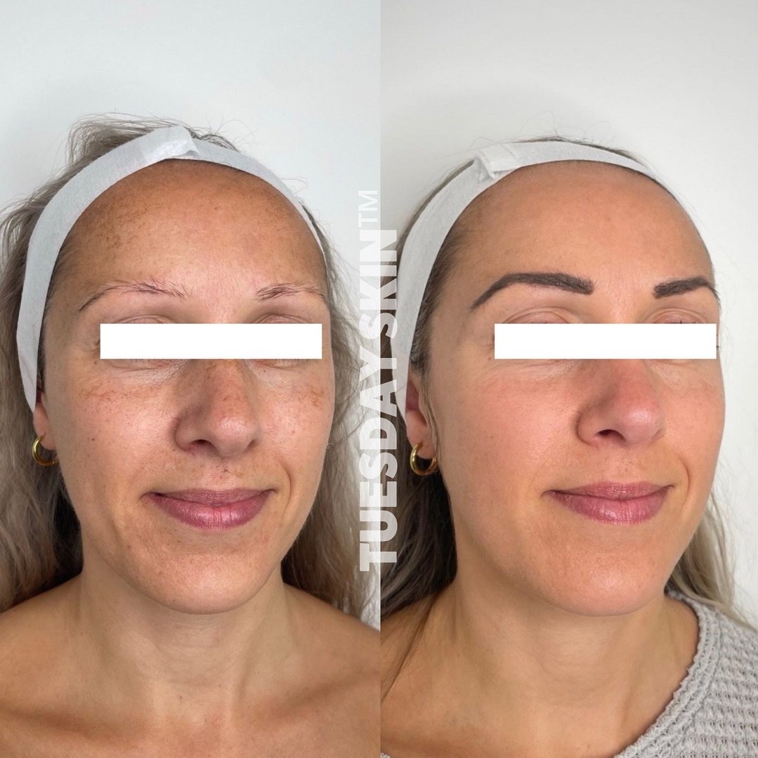 Skin Therapies Pricing - Tuesday Skin Studio, Northland, NZ — Tuesday ...