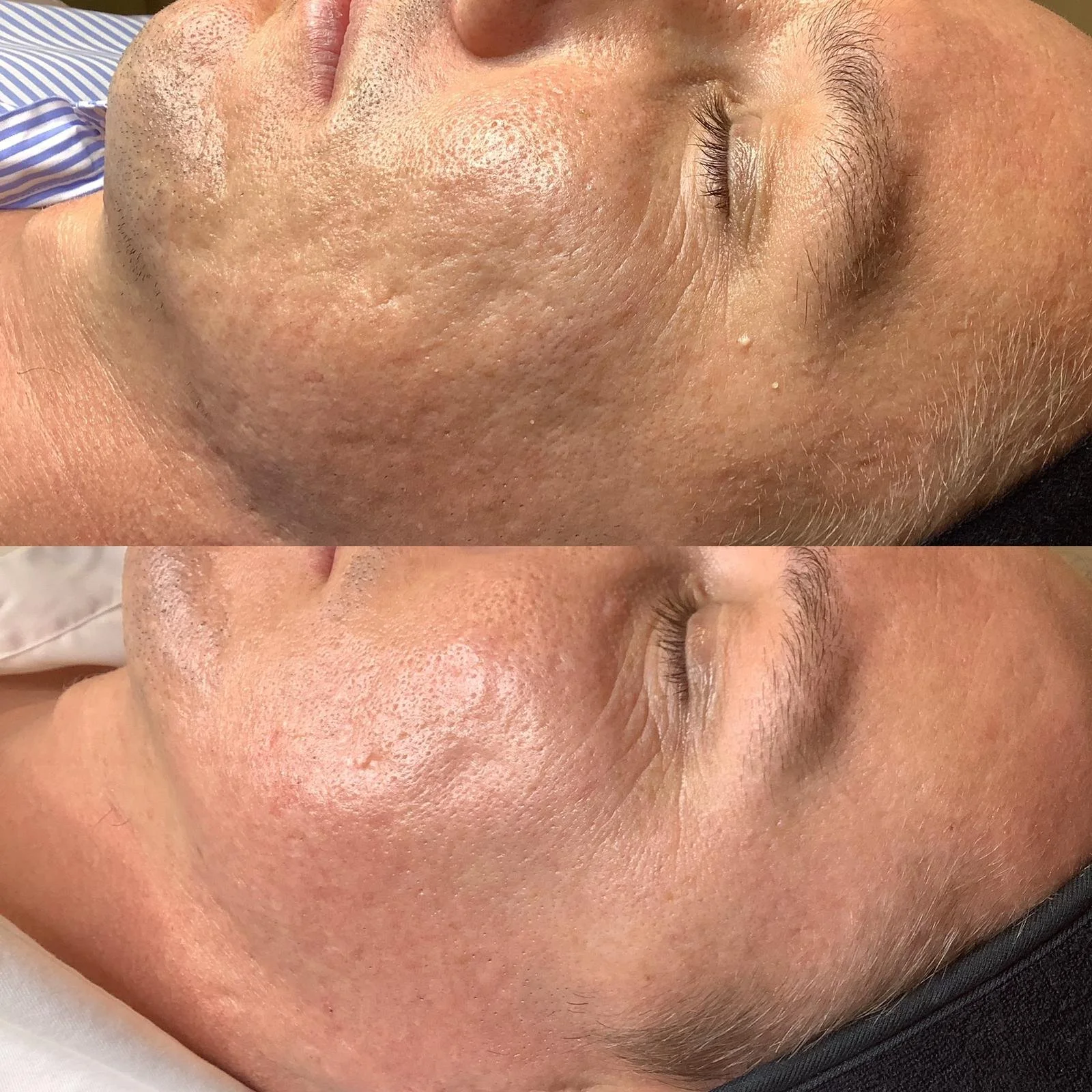 Skin Needling — Light Years Skin Studio