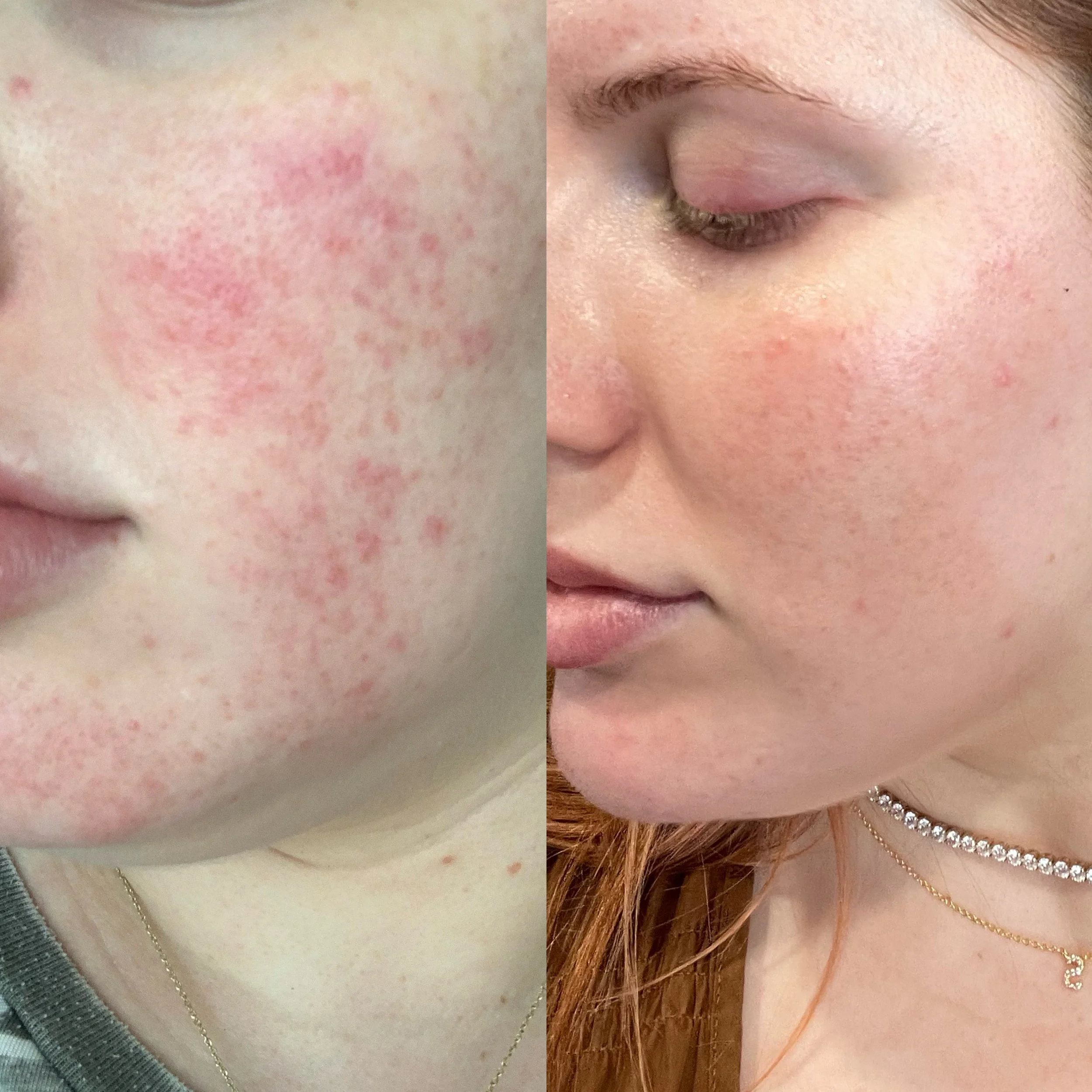 LED Light Therapy — Light Years Skin Studio