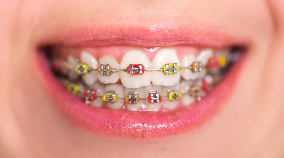 Braces Color Combos — Good Day Orthodontics | Santa Maria, CA