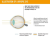 MiYO Smart | Discover Myopia Solutions Today — Johnson & Leatherbarrow