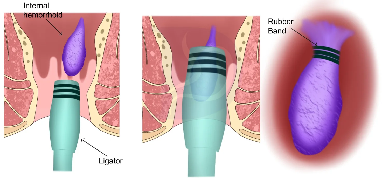 Hemorrhoid Banding — Boston Specialists